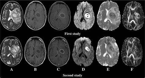 A 25 Year Old Patient Of Brain Abscess Showing Lesion In The Left