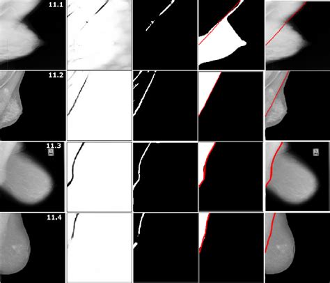 Figure 11 From Breast Pectoral Muscle Segmentation In Mammograms Using