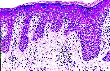 Mycosis Fungoides Histology