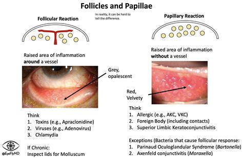 Viral Conjunctivitis Follicles Conjunctivitis Anesthesia Key