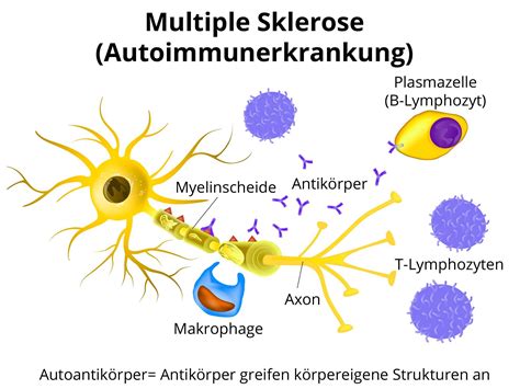 Multiple Sklerose Ms