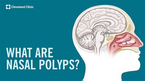 What Are Nasal Polyps Youtube