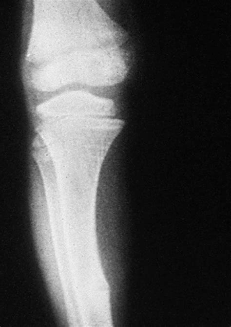 Chapter 13 Metabolic Bone Disease Orthogate Press