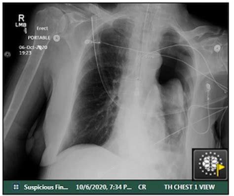 Ai Pneumothorax Radiology Radres Diagnostic Imaging®