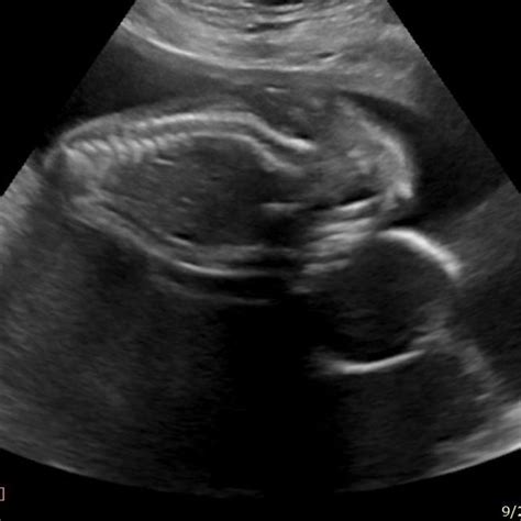 Postnatal Image Of The Dicephalus Tetrabrachius Dipus Twin A Download Scientific Diagram