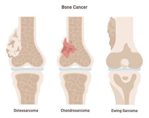 Bone Cancer Vs Bone Marrow Cancer Key Differences You Need To Know