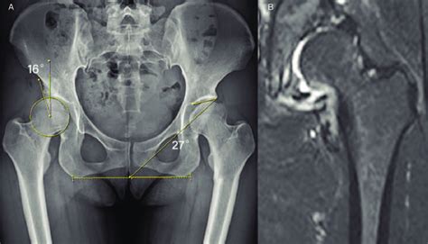 A Demonstrates A Lateral Center Edge Angle Of The Right Hip Of 16° Download Scientific