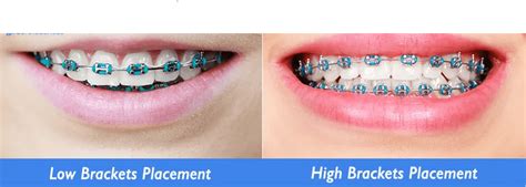 Types Of Brackets And Bracket Placement Ward Campbell Orthodontics