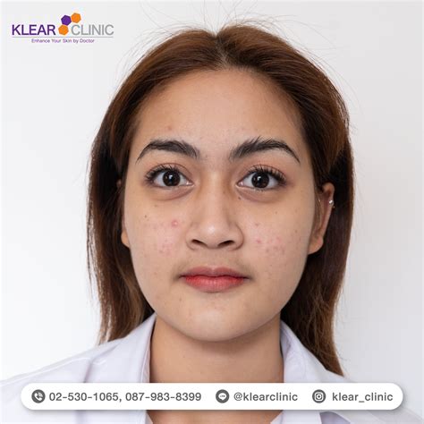 🎉เคลียร์คล Klear Clinic เคลียร์ คลินิกเฉพาะทางด้านผิวหนัง