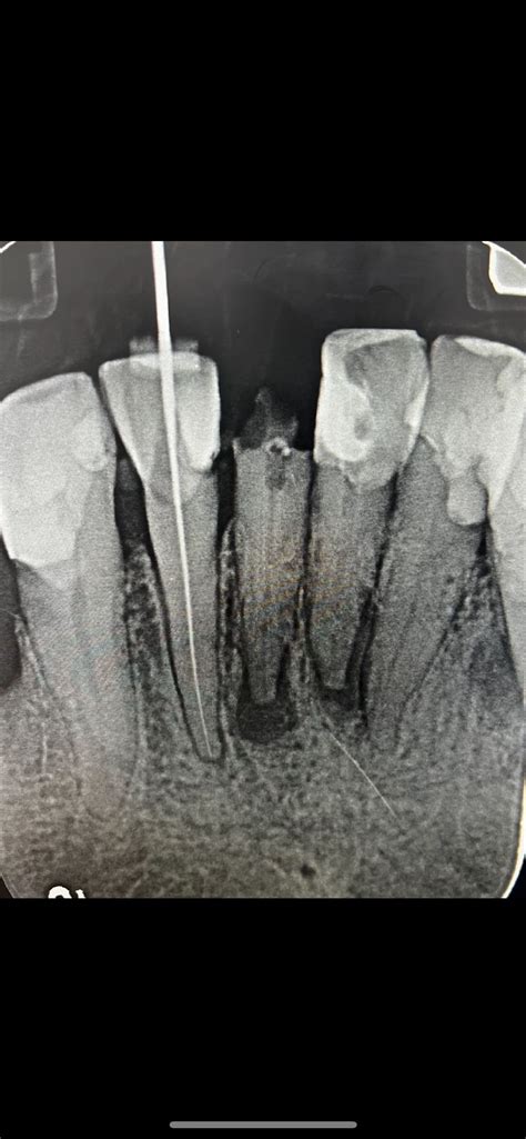 Control Radiográfico De Endodoncias Unirradiculares Diagnóstico Pulpar