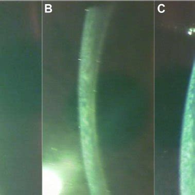 A Intraoperative View Of Cornea After Debridement Of Corneal