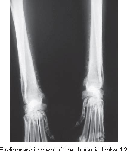 Pdf Hypertrophic Osteopathy Associated With Renal Pelvis Transitional