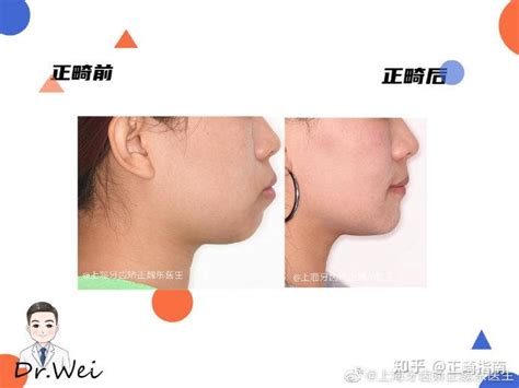 臻威口腔牙齿双颌前突个别牙反颌案例 知乎
