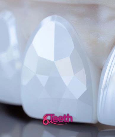 Pro Veneers