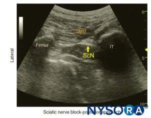 Ultrasound Guided Sciatic Nerve Block Nysora