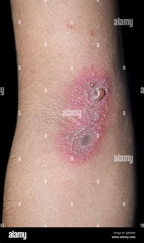 Paederus Dermatitis In Arm It Is A Peculiar Irritant Contact One