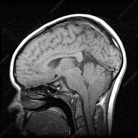 Mri Of Severe Chiari I Malformation Stock Image C0271659 Science