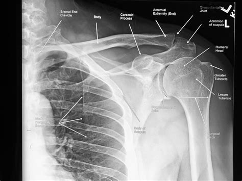 Pin On Humerus Shoulder Radiology Imaging Medical Anatomy Medical
