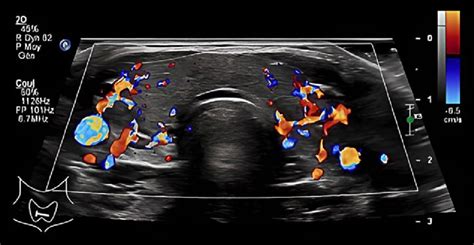 Ultrasonographie De La Glande Thyroïde Dans Le Cadre Dune Maladie De