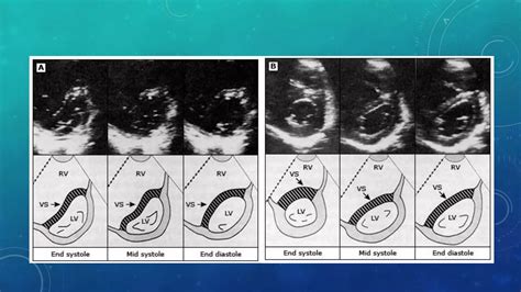 Assessment Of Rv Function Pptx
