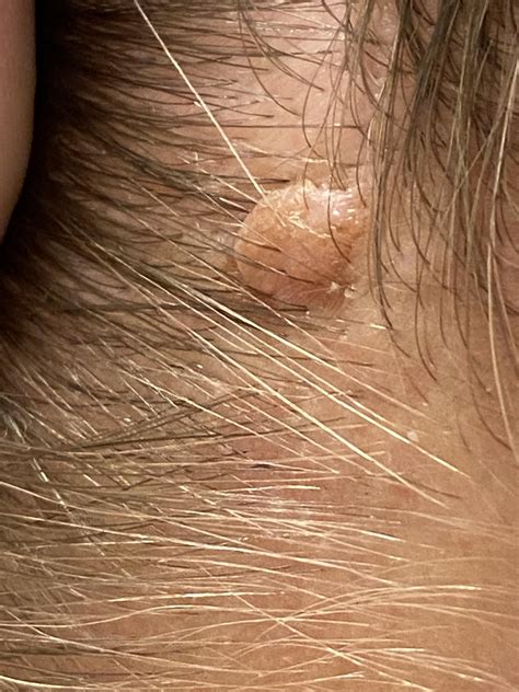 Is This Scalp Nevus Rdermatologyquestions