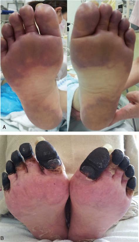 Complement Mediated Thrombotic Microangiopathy Secondary To Sepsis