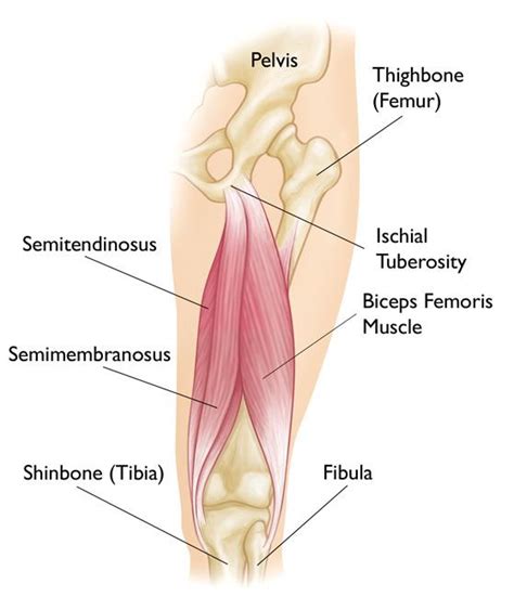 Avulsion Tear Hamstring