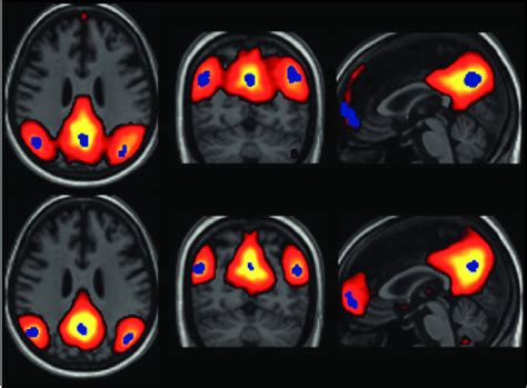 The Z Transformed Default Mode Network Component From Group Ica In A Download Scientific
