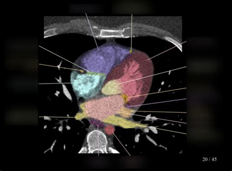 Radiology Case Stack 12 Axial Cardiac Ct 8 Diagram Quizlet