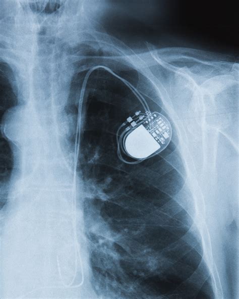 Pacemaker Placement Cardiac Services St Vincents Private Hospitals