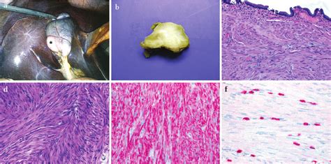 A Laparoscopic View Of The Gallbladder Showing The Tumour Bulging