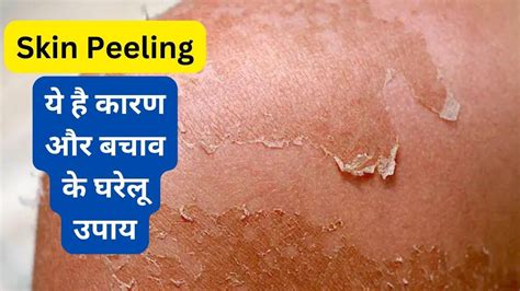 जानें क्या होती है Skin Peeling गर्मियों में बचाव के ये है तरीके