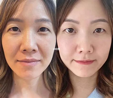 跟抗衰来个和解，这算成功了吧 主要做了眼周和口周的抗衰，半个月的时间，脸紧致，我的青春回来了。成都抗衰 韧带提升 花瓣网