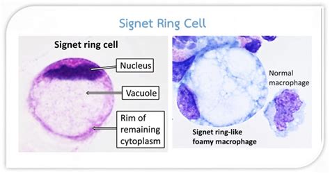 Signet Ring Cells Explained Key Marker Of Aggressive Gastric Carcinoma