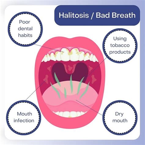 How To Deal With Halitosis Remedies For Fresh Breath