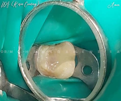 Indirect Composite Onlay Restoration Myzerodonto