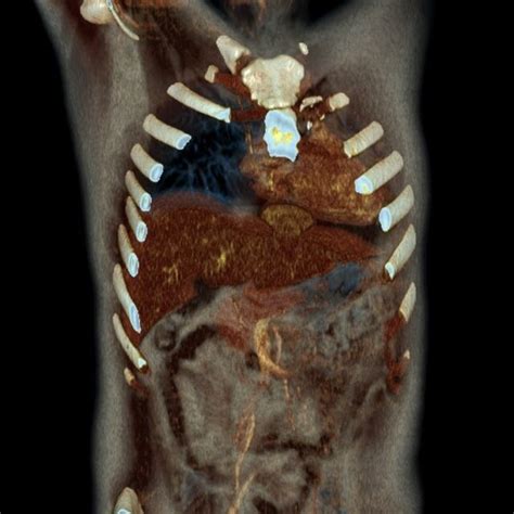 Electrocardiogram Showing Minor Inferior Repolarization Disturbance And