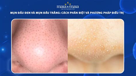 Mụn đầu đen Và Mụn đầu Trắng Cách Phân Biệt Và điều Trị