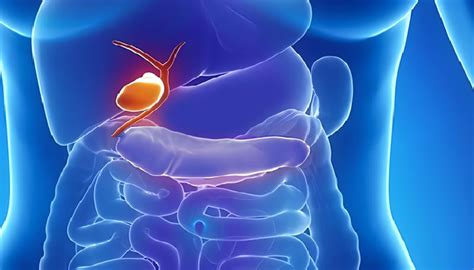 Diagnóstico De Íleo Biliar Obstrucción Intestinal Fístula Biliar