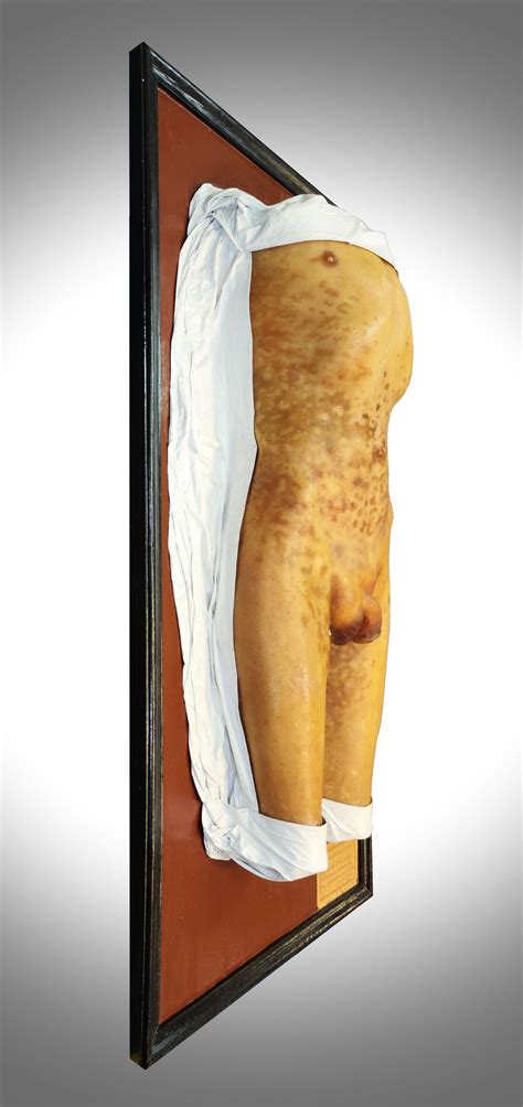 Eritrodermia Salvarsánica Con Pigmentación Consecutiva Museo Olavide