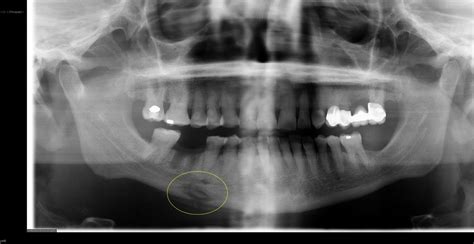 Osteomyelitis Radiology Jaw At Brandon Myers Blog