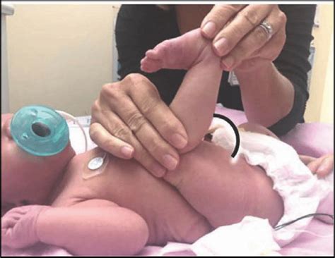 Popliteal Angle In A Term Neonate ~90 Degree Angle Download