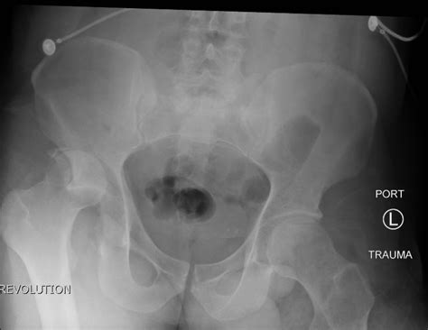 Hip Dislocation Pre And Post Reduction Xr Jetem