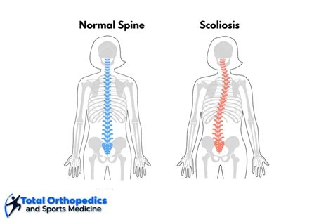 Can Bad Posture Cause Scoliosis Total Ortho Sports Medicine
