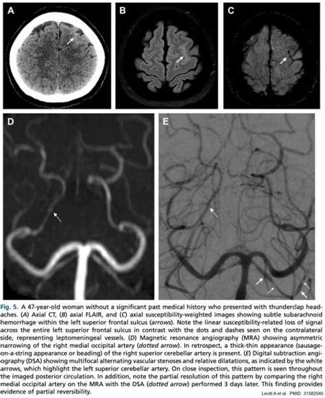 Reversible Cerebral Vasoconstriction Syndrome Rcvs Emcrit Project