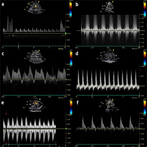 Echocardiographic Assessment Of Cardiovascular Physiology Of Preterm
