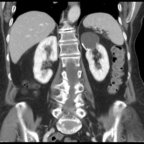 Bosniak Classification System Of Renal Cystic Masses Pacs