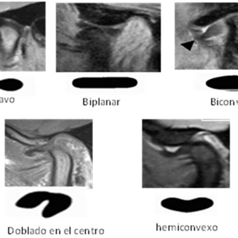 Articular Disc Configuration Classification According To Murakami Et