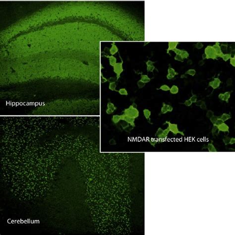 Anti Nmda Receptor Encephalitis Compared To Other Neuroautoimmune Download Scientific Diagram