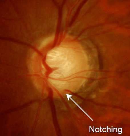 Optic Nerve Cupping Notching Oogzenuw